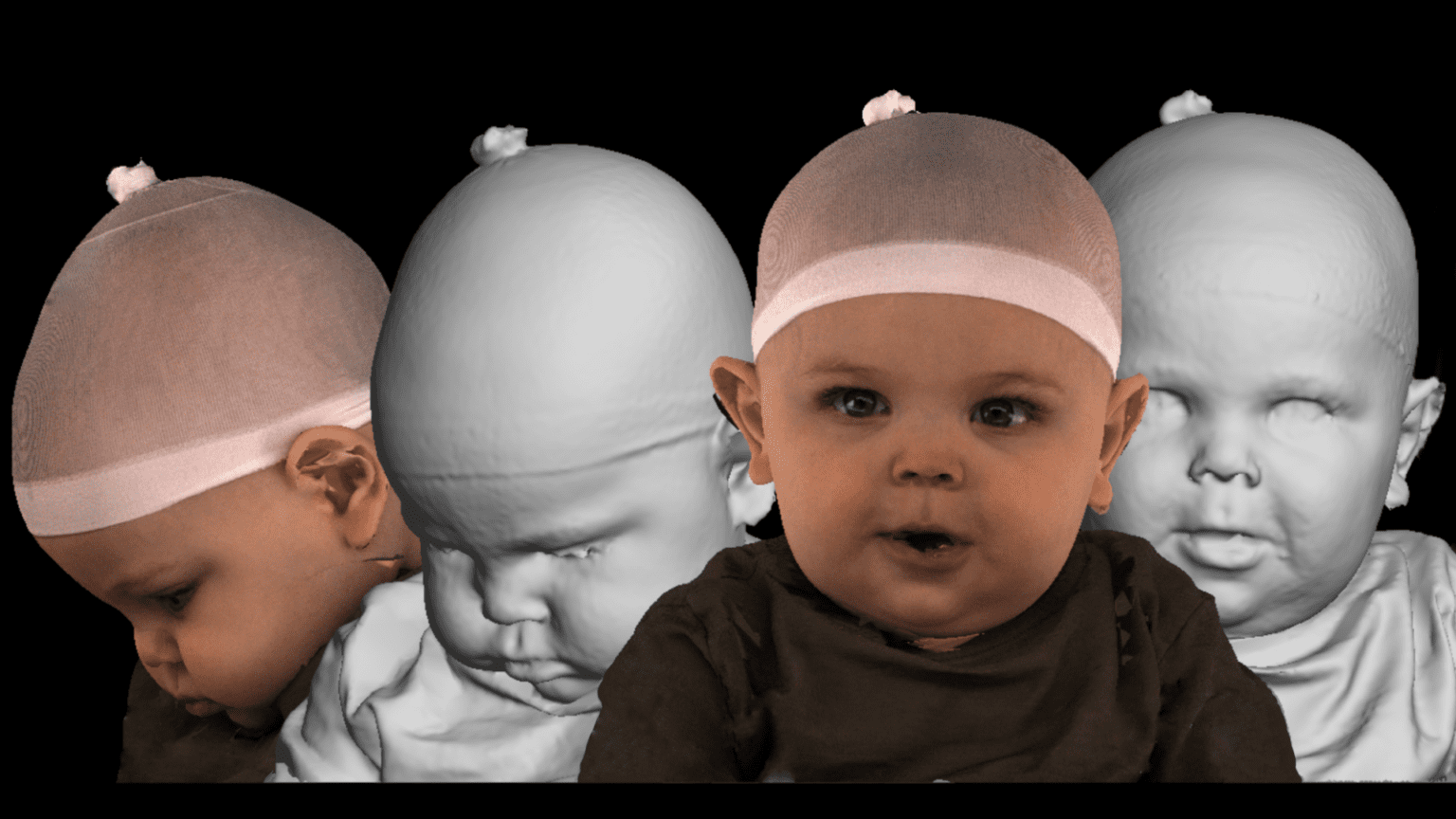 Researchers using 3D facial scans to aid diagnosis of children with ...